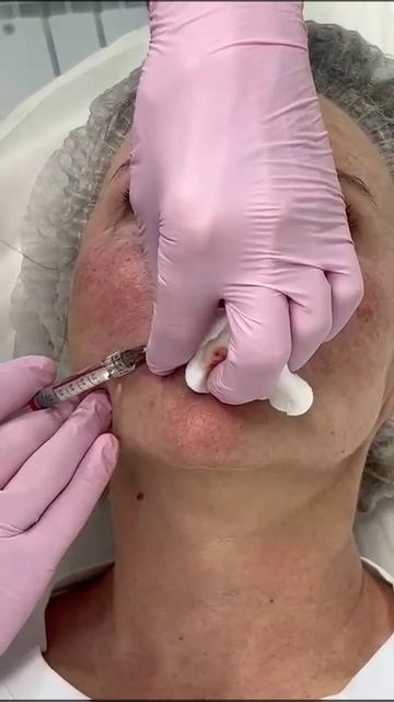 Belotero Lips Shape: коррекция формы губ