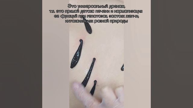 Постановка пиявок на печень