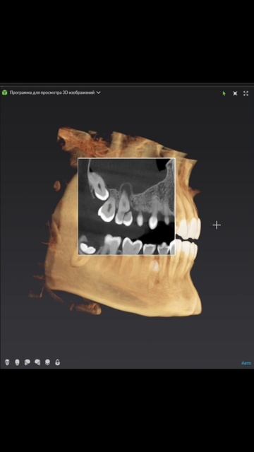 Андрей Молчанов, врач-рентгенолог делится примером визуализации области 1.6 зуба в DTX Studio.