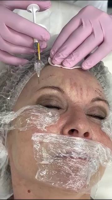 Belotero Soft в технике «бланшинг»: лоб