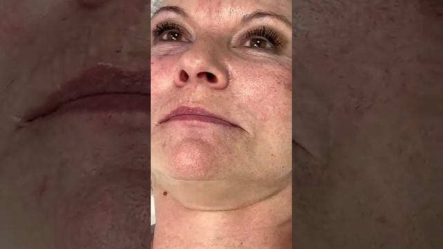 Belotero Soft в технике «бланшинг»: морщины над верхней губой