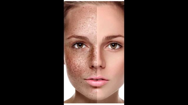 Маски для лица. Как избавиться от пигментных пятен после солнца.