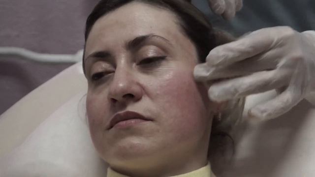 Результат Шлифовки Лица с Лазером CO2 Фраксель  (Тирасполь и Бендеры)