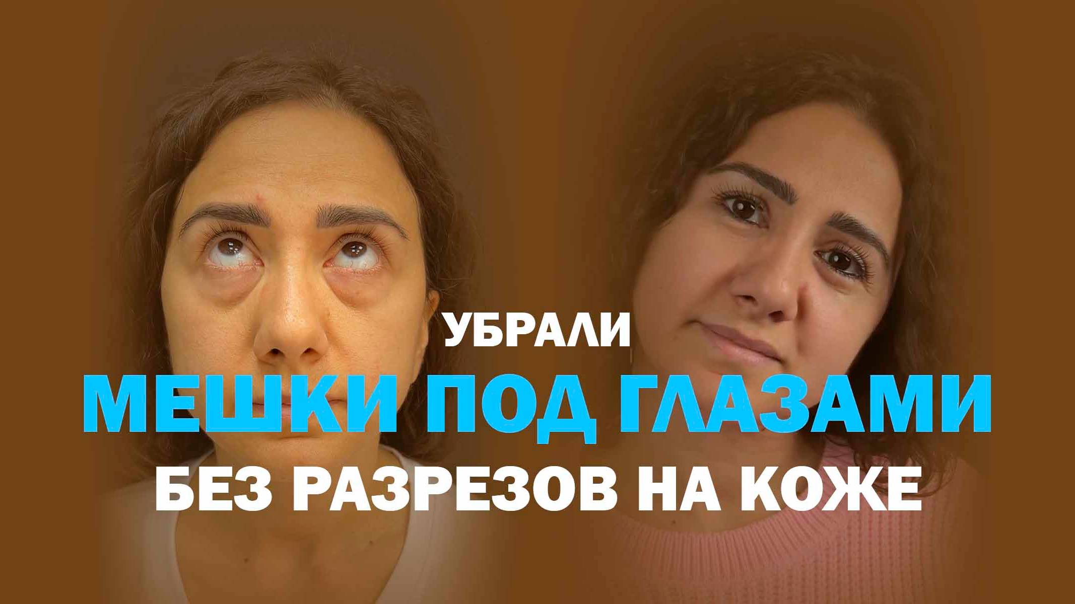 Тихая революция: пластика нижних век без разрезов и без следов