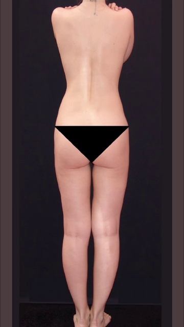 РУЧНАЯ ПЛАСТИКА ТЕЛА. КОРРЕКЦИЯ ФИГУРЫ. РЕЗУЛЬТАТ ДО И ПОСЛЕ. ВИДЕО КЛИП 4.