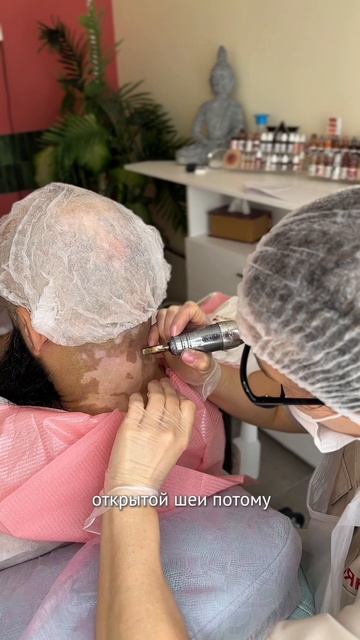 Убрали пятна витилиго на шее