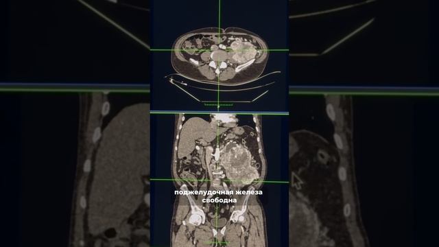 🔎На снимках: огромная опухоль левой почки