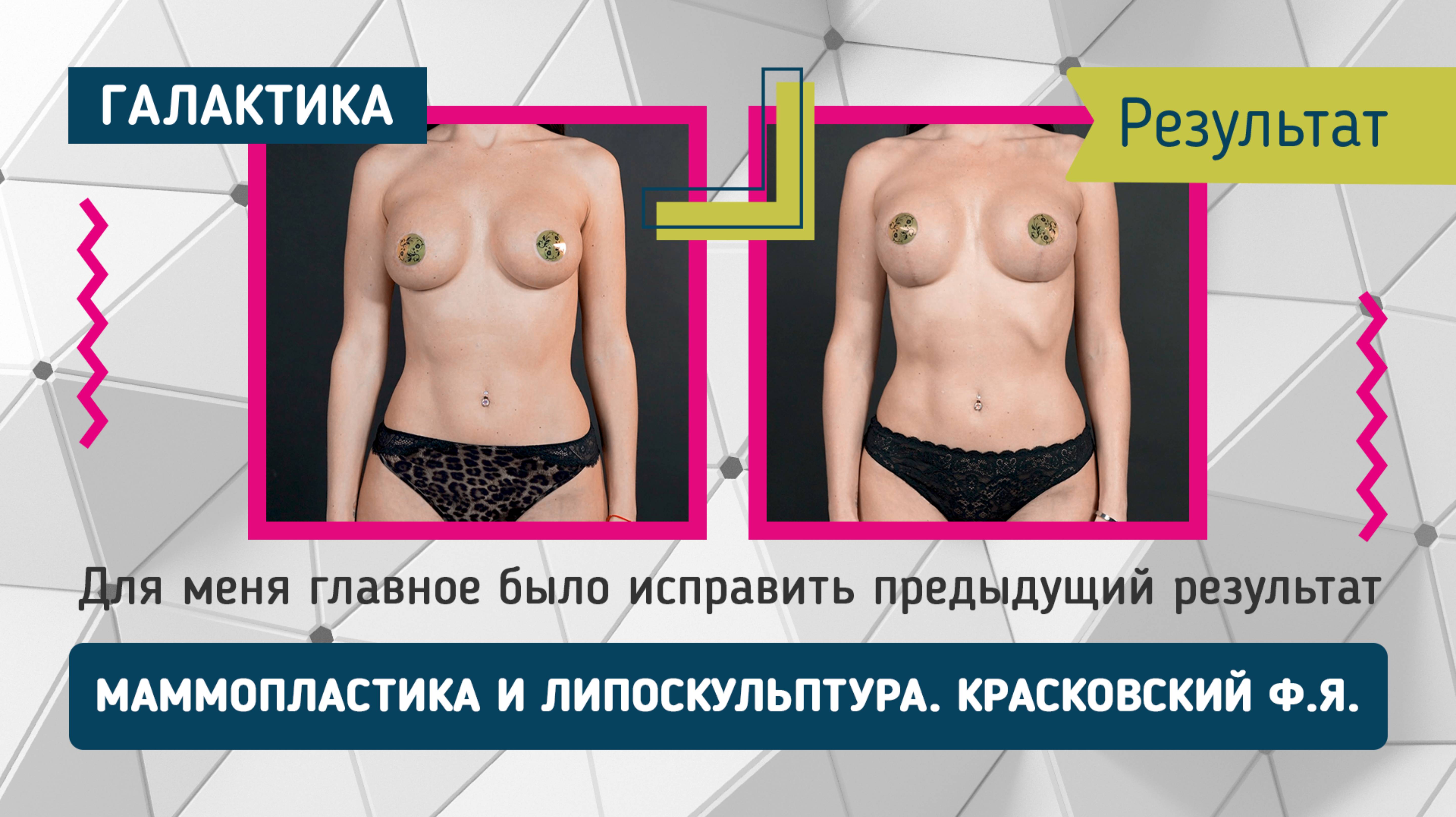 Вторичная пластика груди и тела: результат спустя 2 месяца у Красковского Федора Яновича