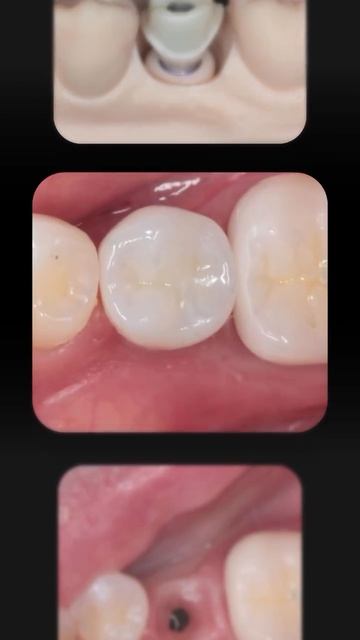 Коронка на имплантате состоит из трёх основных частей