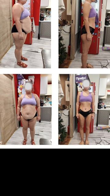 Результаты моей прекрасной пациентки: минус 39 кг после минигастрошунтирования.