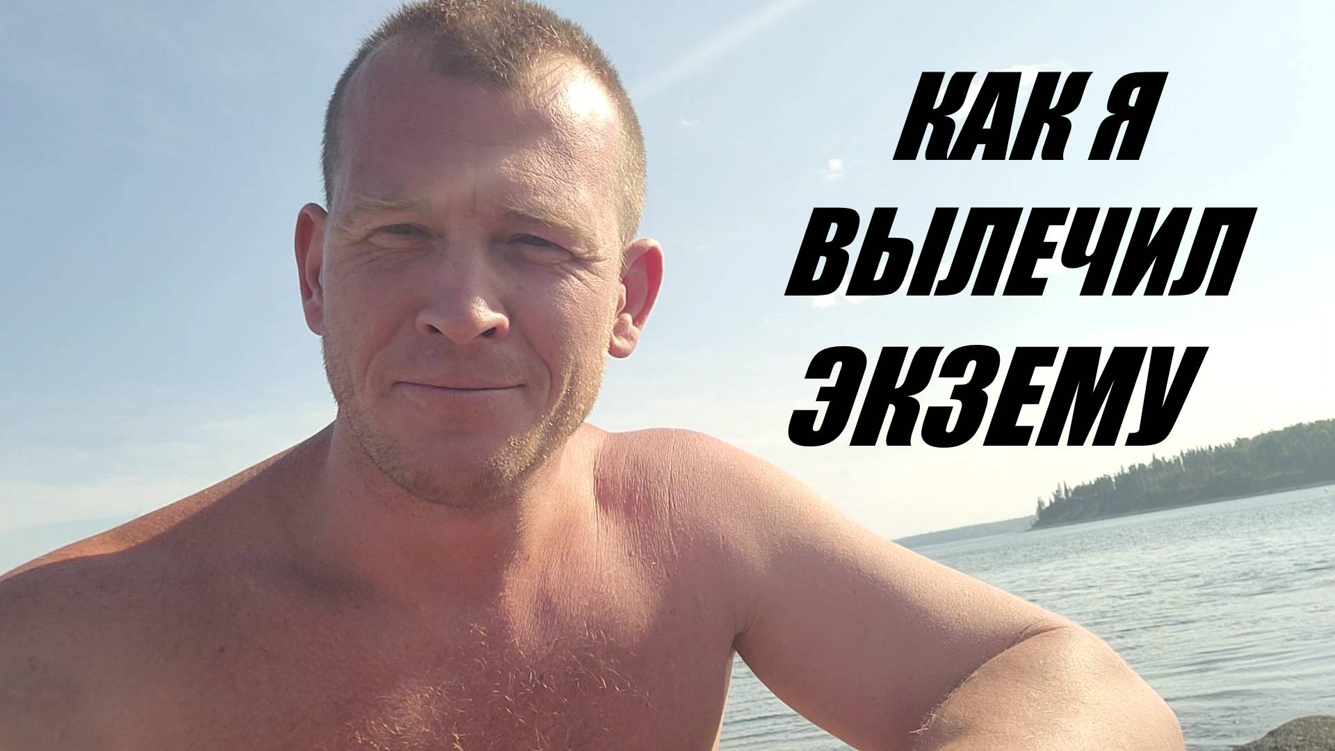 Как я вылечил сильную многолетнюю Экзему (диатез, дерматит, кожную аллергию)