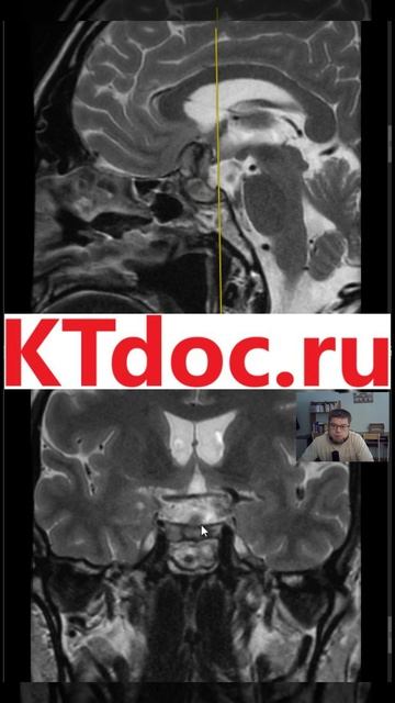 Образование_селлярной_области