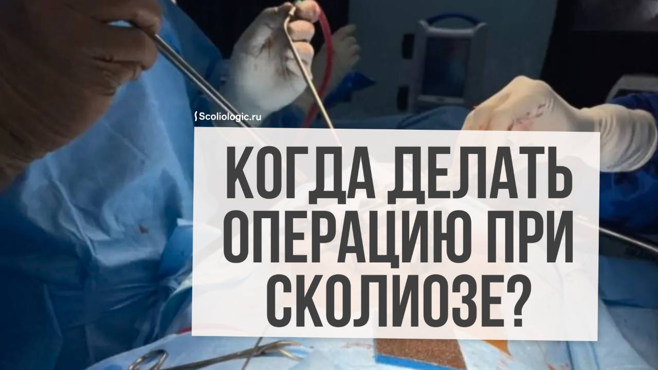 Когда лучше делать операцию при сколиозе
