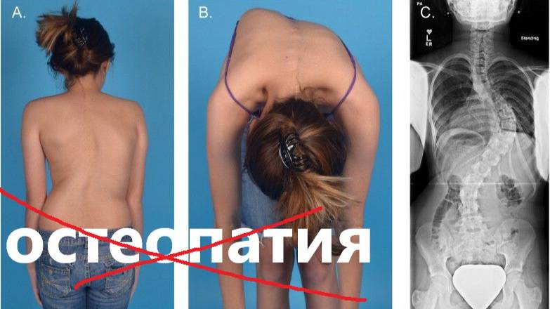 Остеопаты!  Сколиоз лечите?