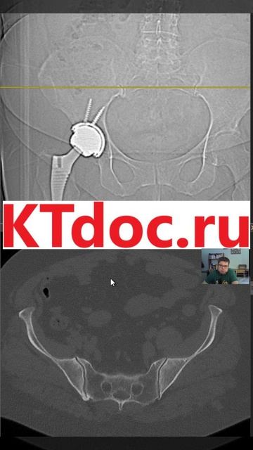 Эндопротез