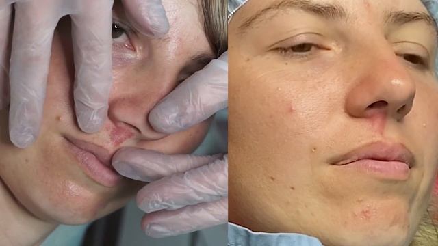 Удаление Винного Пятна- Результат После Второй Процедуры