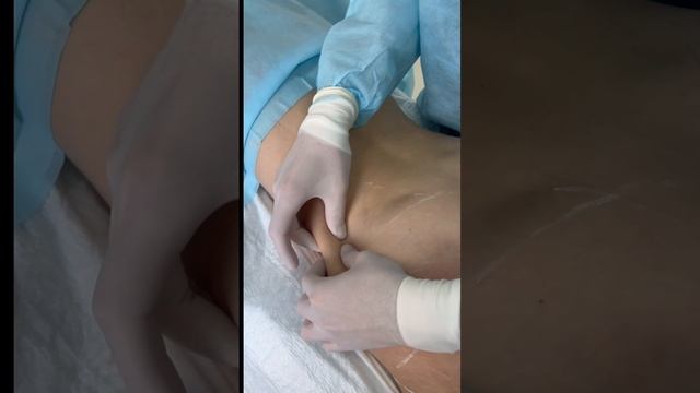 #липомоделирование: коррекция фигуры