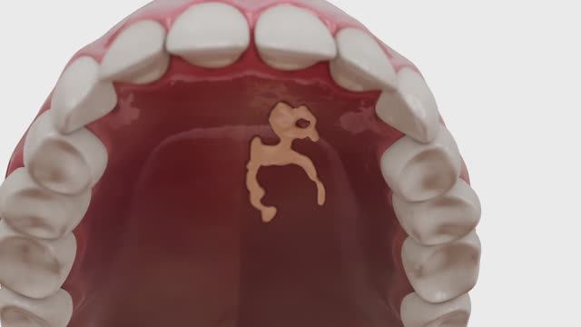 Применение средств Фитодент № 1.1. Стоматит герпетический