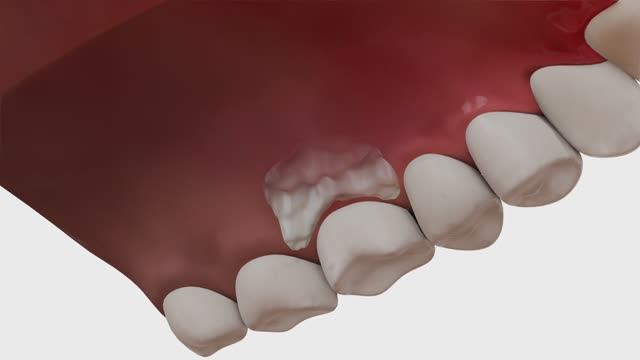 Применение средств Фитодент № 5 Термическая травма