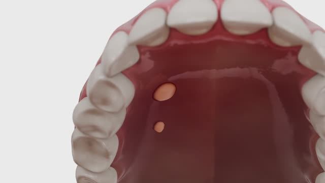 Применение средств Фитодент № 1.2. ХРАС (хронический рецидивирующий афтозный стоматит)