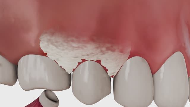 Применение средств Фитодент № 4 Химическая травма