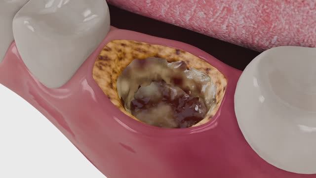 Применение средств Фитодент № 12 Обострение хронического остеомиелита