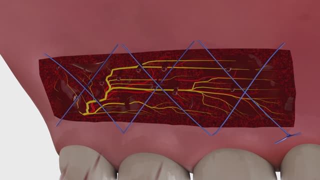 Применение средств Фитодент № 17 Хирургическое купирование послеоперационных кровотечений