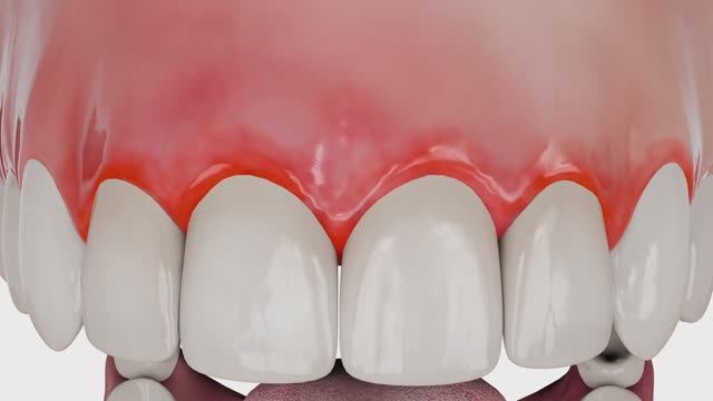 Применение средств Фитодент № 18 Катаральный гингивит