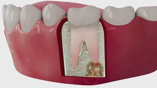 Применение средств Фитодент № 9 Периостит