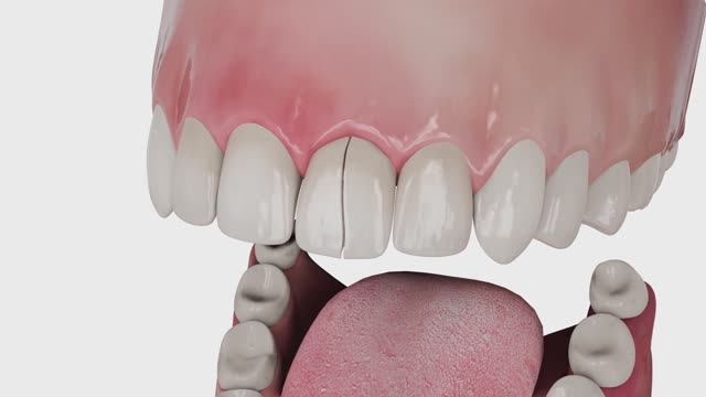 Применение средств Фитодент № 13 Асептическое удаление зуба (перелом корня)