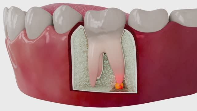 Применение средств Фитодент № 8 Обострение хронического периодонтита