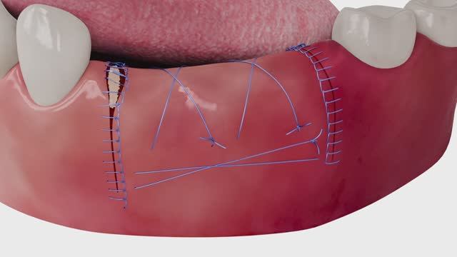 Применение средств Фитодент № 2.1. Расхождение швов