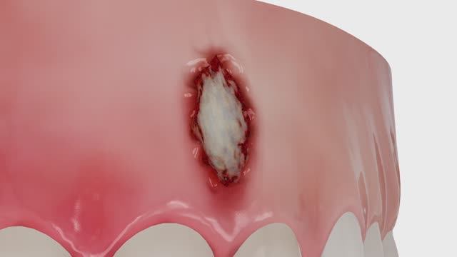 Применение средств Фитодент № 6 Ятрогенная травма