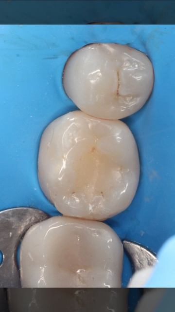 Ключ к идеальной реставрации в деталях