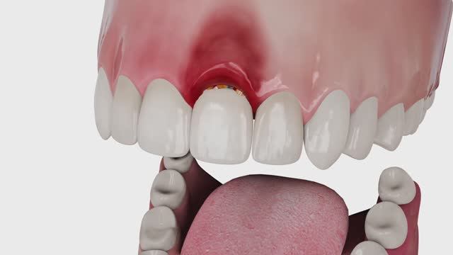 Применение средств Фитодент № 14 Обострение хронического периимплантита