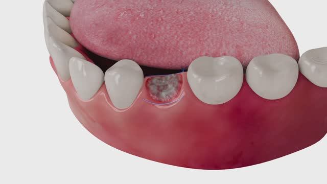 Применение средств Фитодент № 2.2. Фиброзный налёт