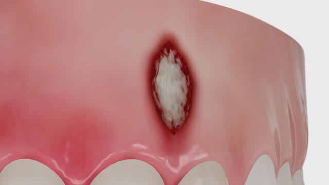 Применение средств Фитодент № 3 Механическая травма