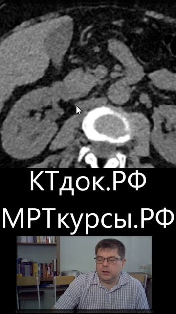 Конкременты желчного пузыря