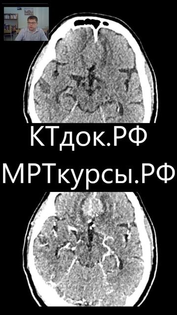 Образование ольфакторной ямки