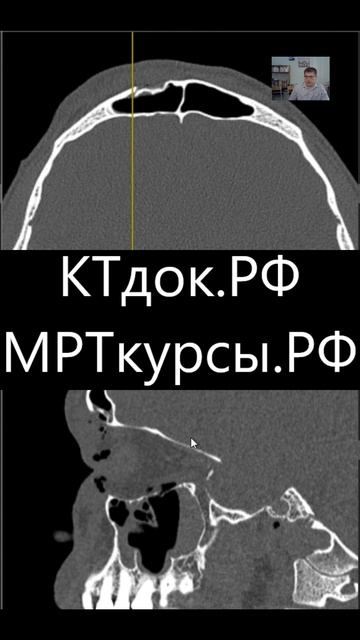Перелом стенок придаточных пазух носа