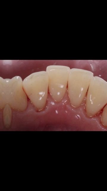 Профессиональная гигиена зубов ДО/ПОСЛЕ  #стоматология #доктор #dentist #shortvideo #гигиена