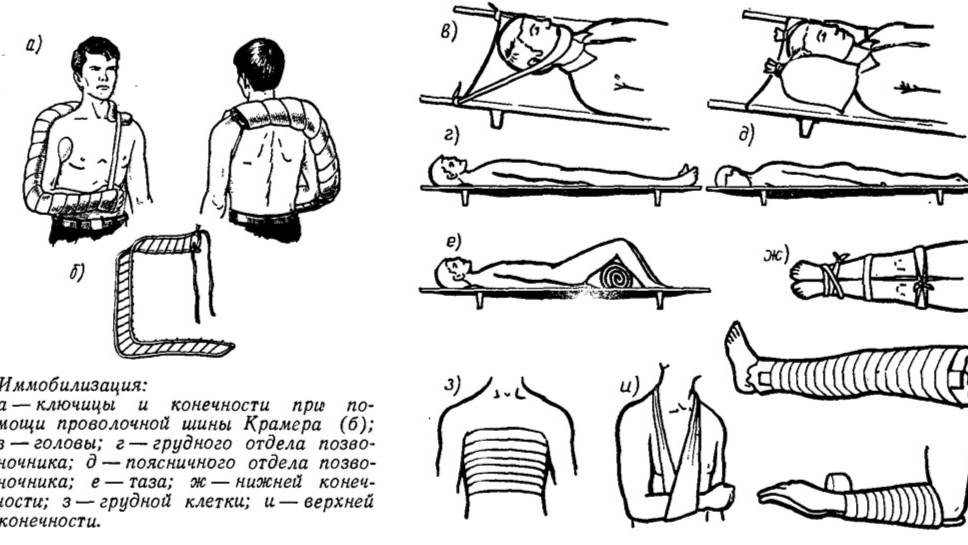 Иммобилизация верхней конечности необычным способом