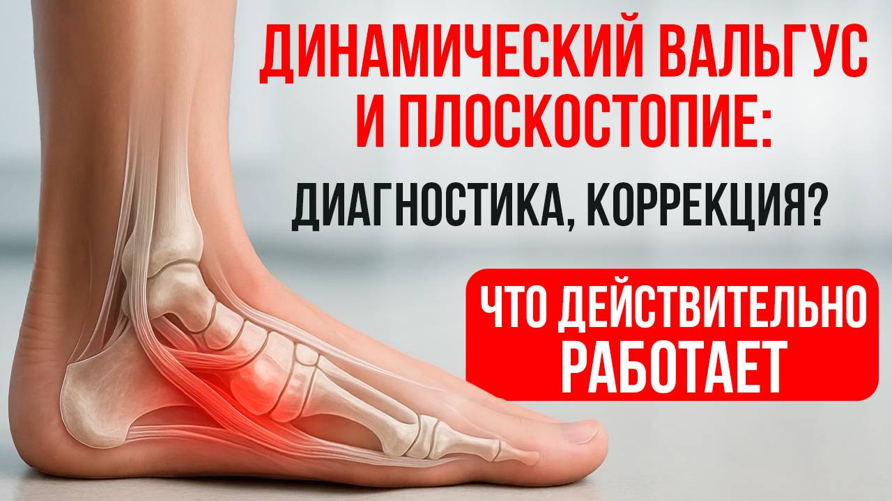 Динамический вальгус и плоскостопие: диагностика, коррекция? Что действительно работает