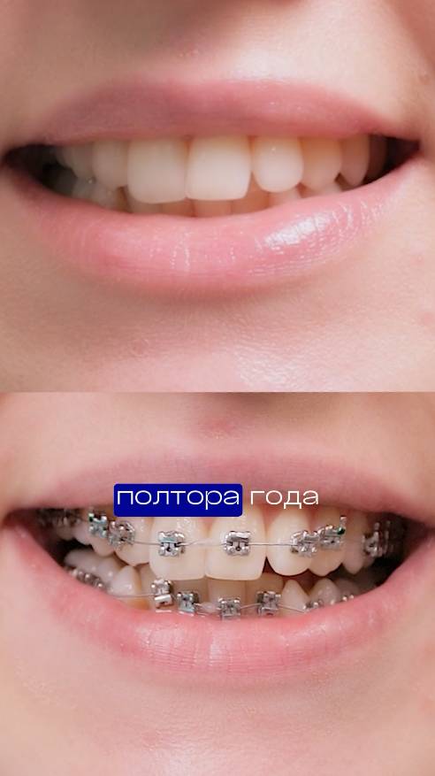 Зачем удалили зуб, чтобы поставить брекеты? #стоматология #брекеты #зубы #удалил #доктор