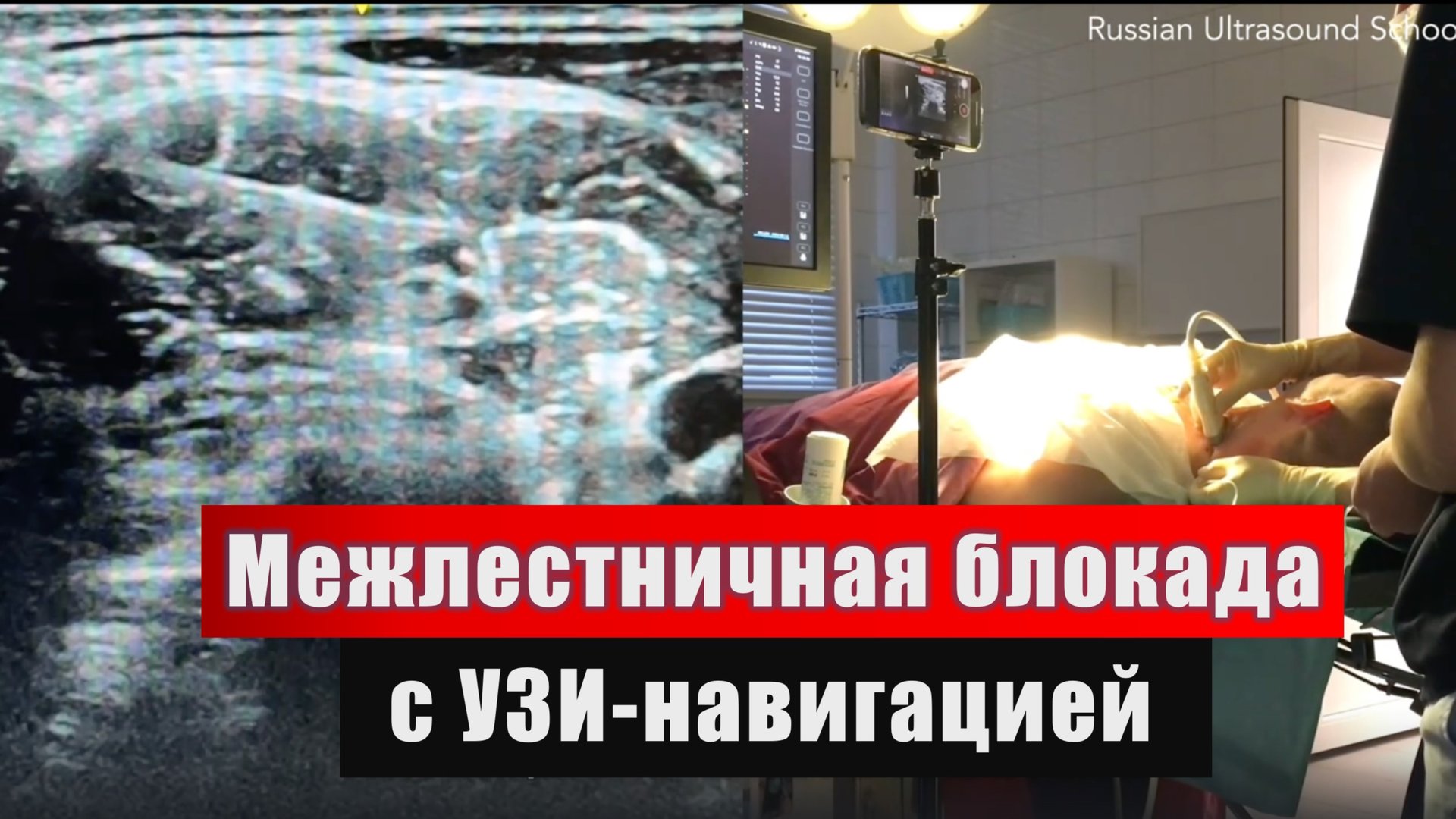 МЕЖЛЕСТНИЧНАЯ БЛОКАДА ПЛЕЧЕВОГО СПЛЕТЕНИЯ
#regionalanesthesia #узинавигация #регионарнаяанестезия