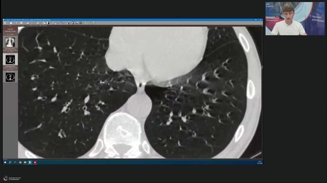 Визуализация бронхов и трахеи в норме и при патологии на примере клинических наблюдений