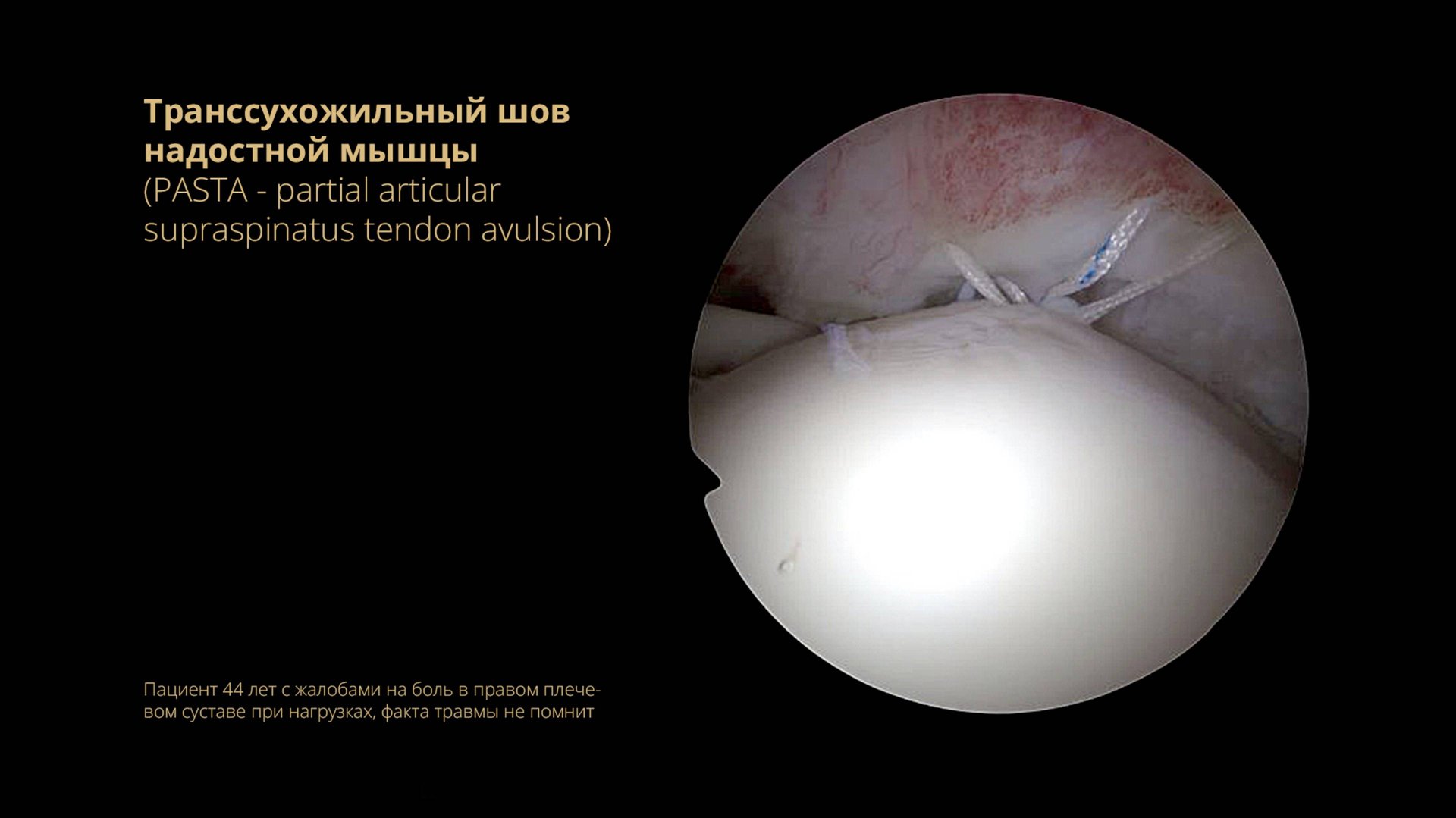 Транссухожильный шов надостной мышцы (PASTA - partial articular supraspinatus tendon avulsion)