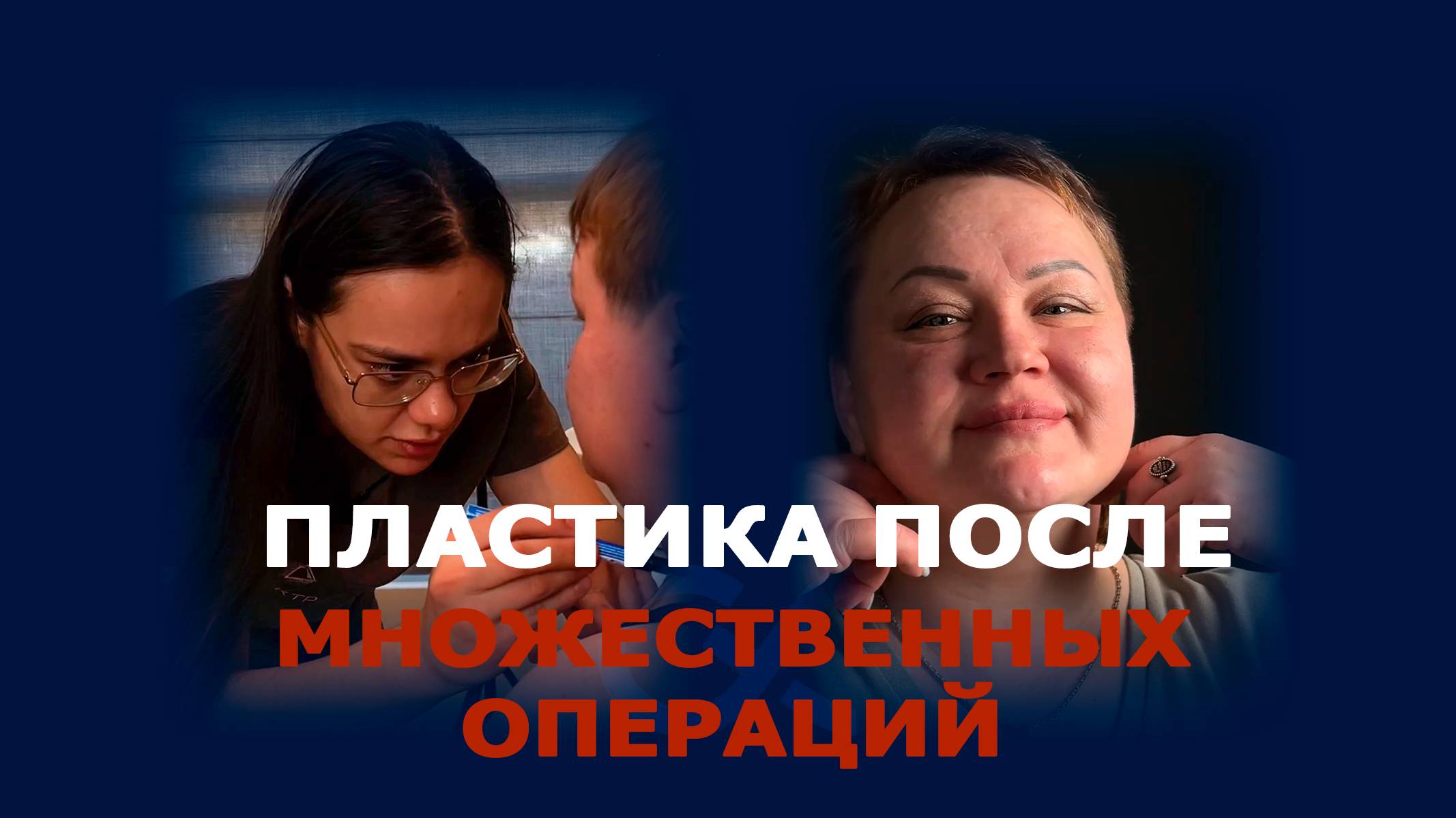 SMAS-лифтинг, платизмопластика и липосакция: итог операции