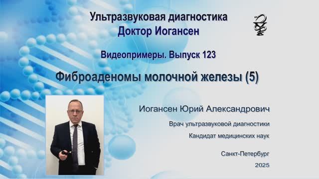 УЗИ. Доктор Иогансен. Видеопримеры. Выпуск 123. Фиброаденома молочной железы (5).