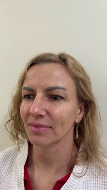 🔥 Deep Plane facelift + платизмопластика + блефаропластика + лобэндоскопия